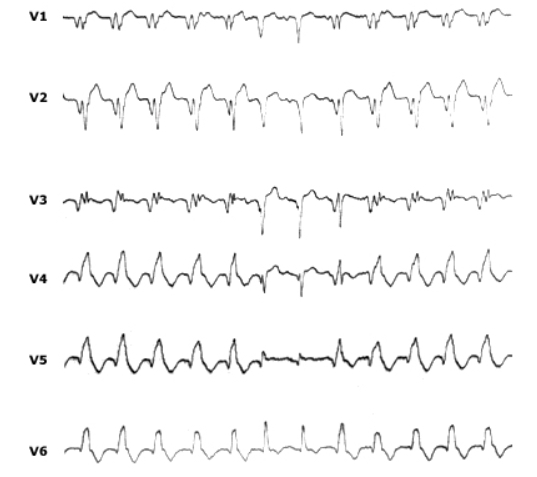 Monomorphic ventricular tachycardia(VT) : 네이버 블로그
