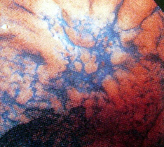 borrmann type : 네이버 블로그